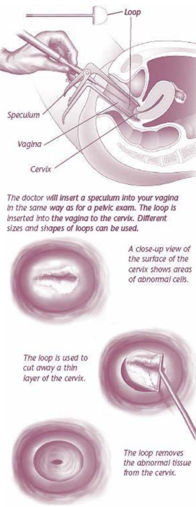 Loop Electrosurgical Excision Procedure (LEEP) - WomenCare of Baldwin Park